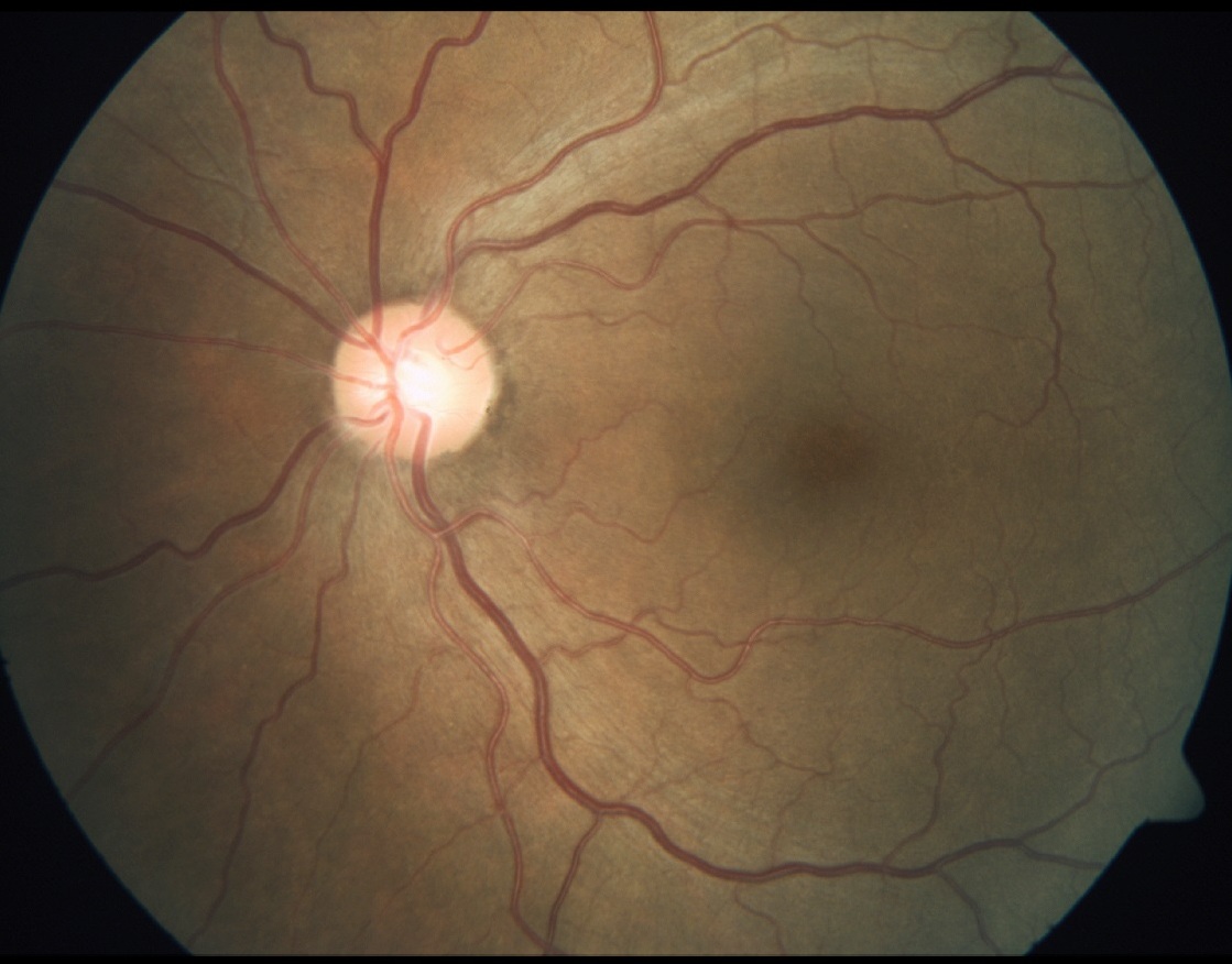 Know About Glaucoma Treatment - Glaucoma Silent Thief of Sight